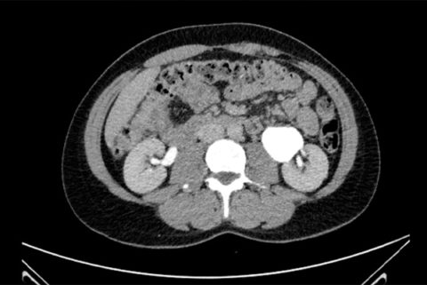 Le syndrome de la jonction pyélo urétérale - Centre d'Urologie Lyon Ouest